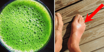 How to Treat Uric Acid Crystallization in Joints for Gout and Joint Pain