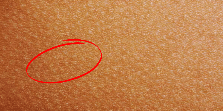 11 Reasons for Raised Bumps on Your Skin – Warning Signs You Shouldn’t ...